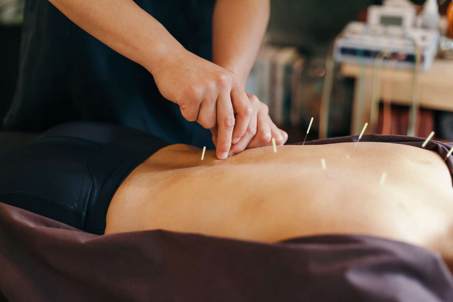 Walk-In Acupuncture Saskatoon | Axis Health Center