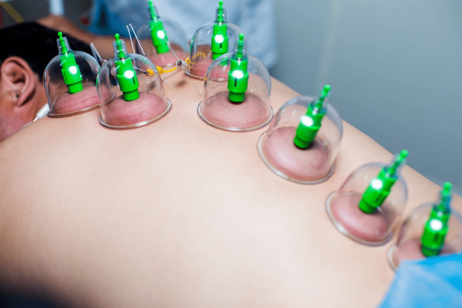 Hijama or Cupping Therapy | Axis Health Center